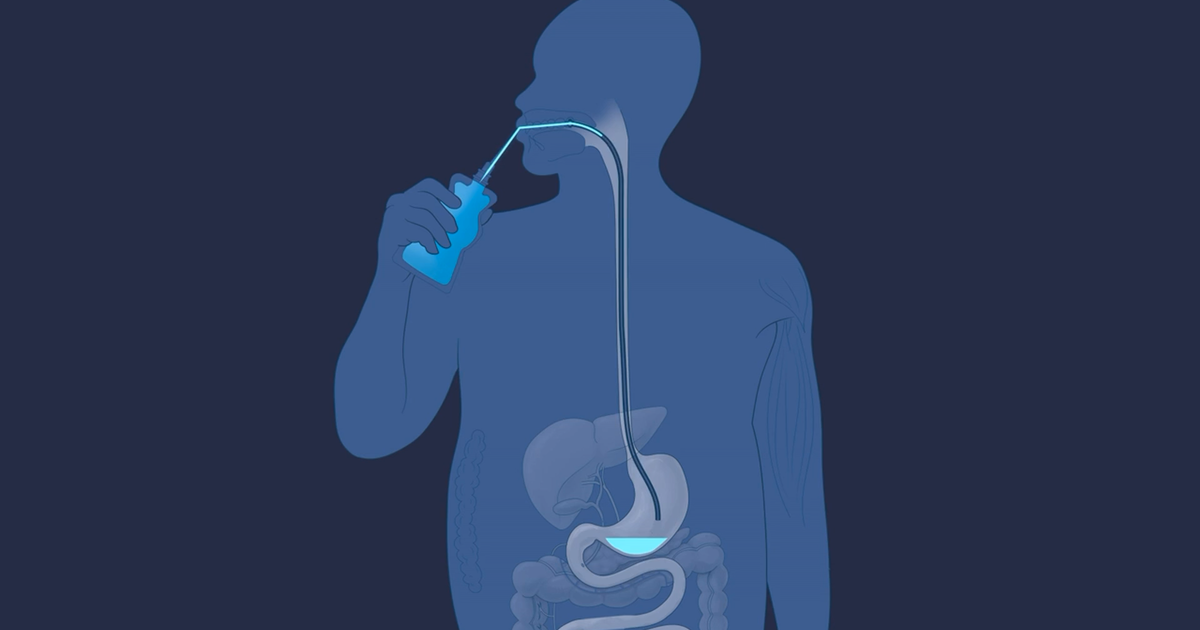 Alsteni Medical — The Invisible, Removable Feeding Tube | Feeding Tube ...